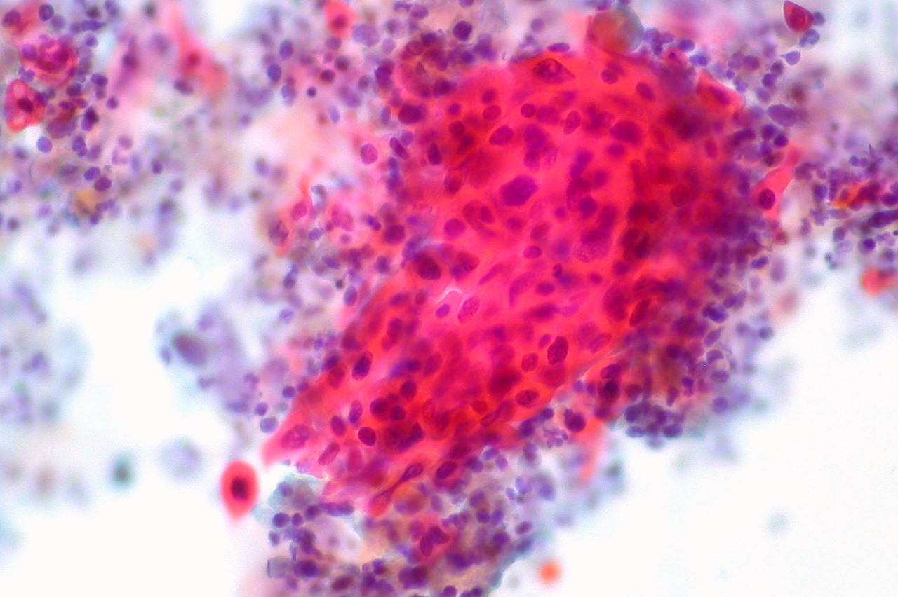 Unlocking the Secrets of Cancer: Microsoft’s Innovative Approach with ...